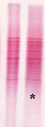Oligoclonal Band pattern - Biomarker.org Novel Biomarker Discovery